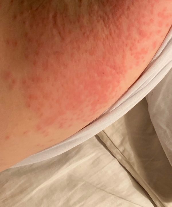 How to soothe a browntail moth caterpillar rash | Catching Health with ...